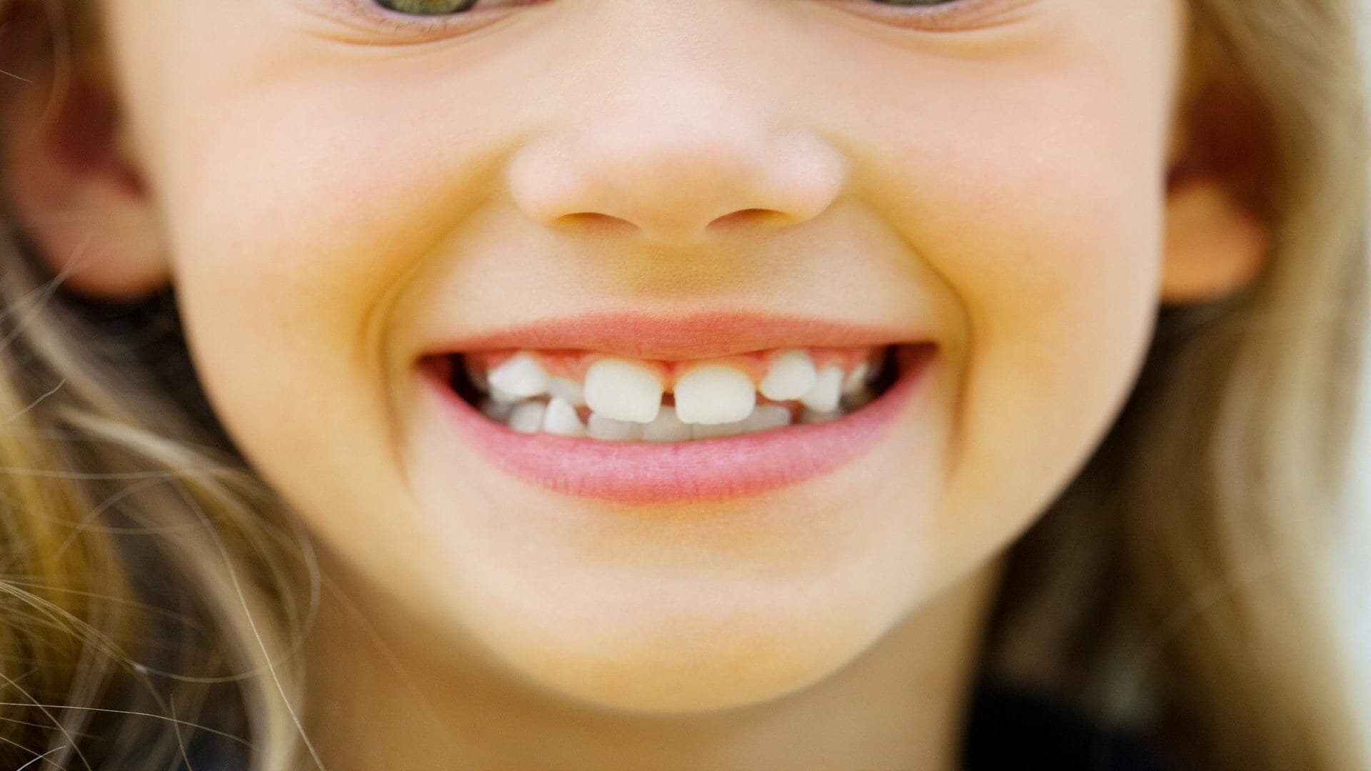 Crooked Teeth | Orthodontics Wellington | Thorndon Orthodontics